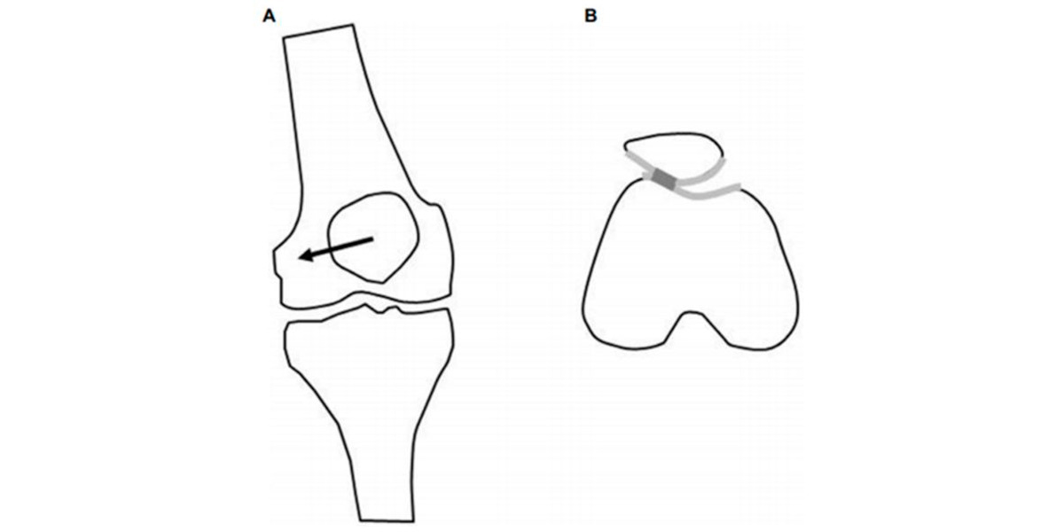 Runner's Knee Syndrome – Causes, Symptoms, Treatment 【2025