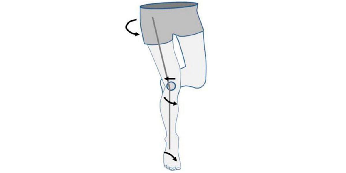 Runner's Knee Syndrome – Causes, Symptoms, Treatment 【2026