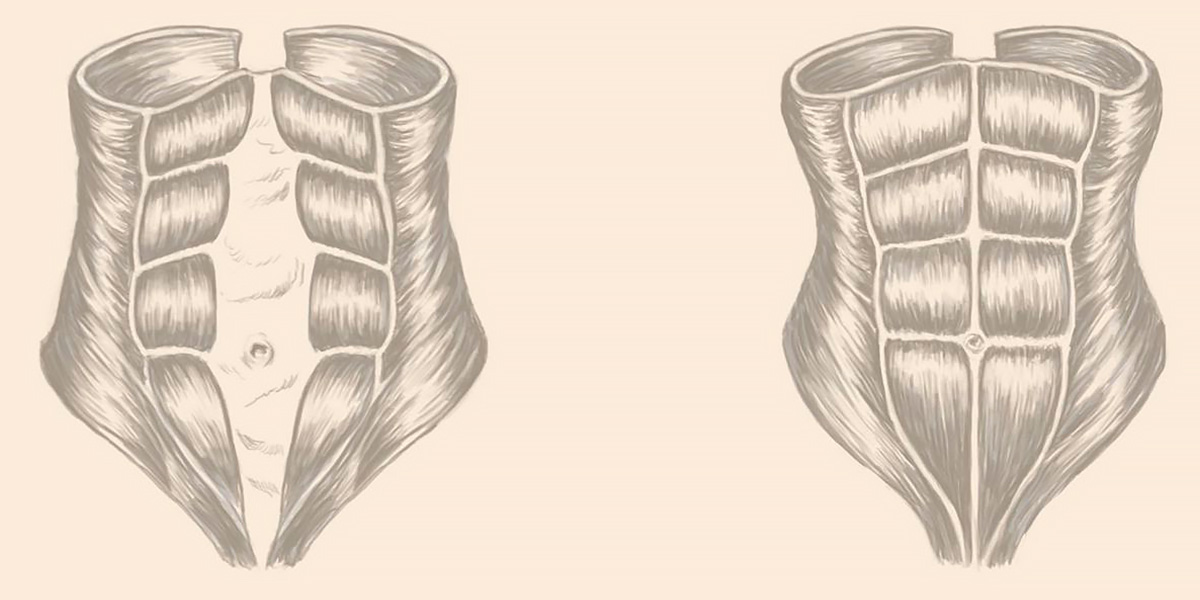 Diastasis Recti – It affects both men and women【2026