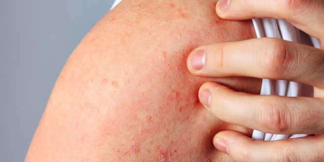 Dermatitis: Causes, types and treatment skin conditions