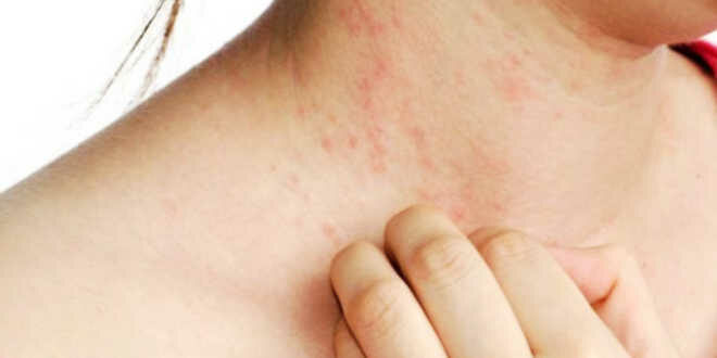 Dermatitis: Causes, types and treatment skin conditions